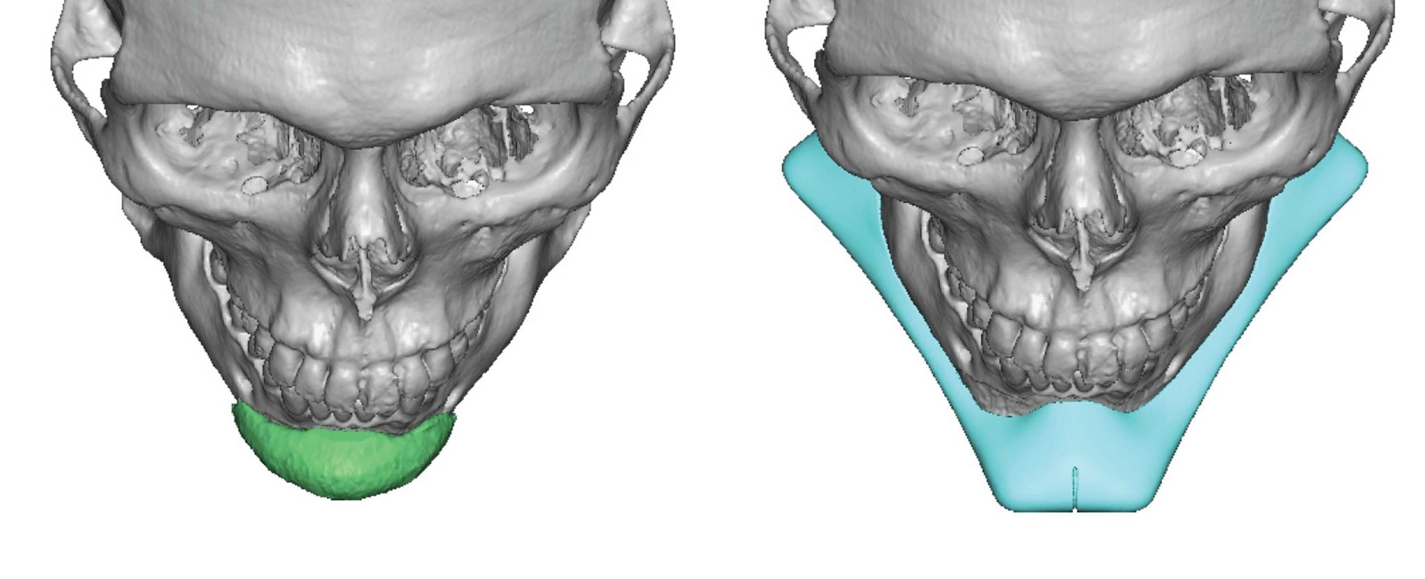 Plastic Surgery Case Study - Chin Implant Replacement with Custom ...
