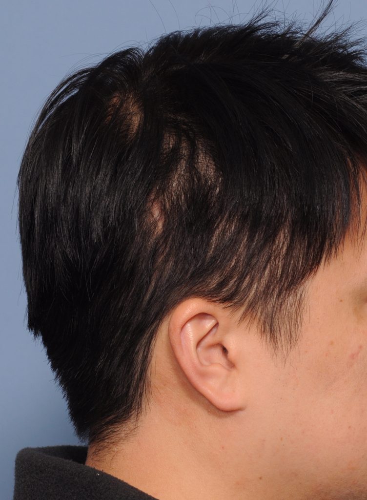 Plastic Surgery Case Study - Long Term Results of Custom HTR Implant ...