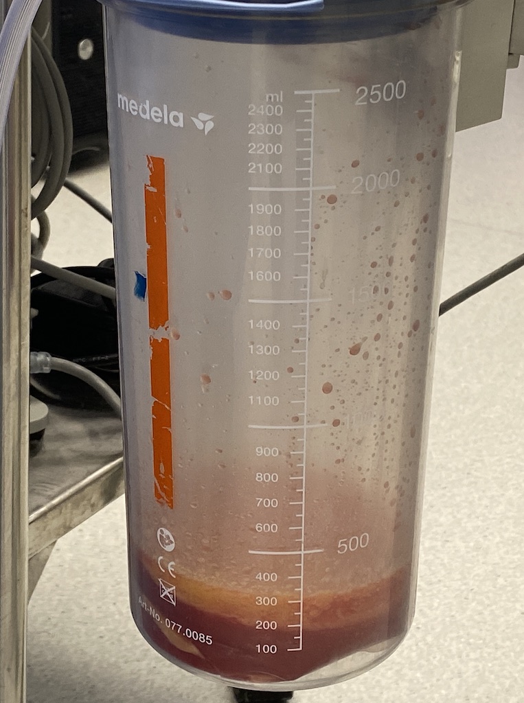 Flank Liposuction in Rib Removal Surgery - Explore Plastic Surgery