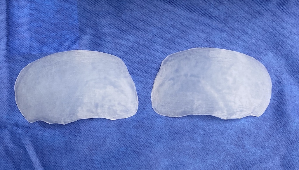 Plastic Surgery Case Study - Custom Head Widening Implants Placed in a ...