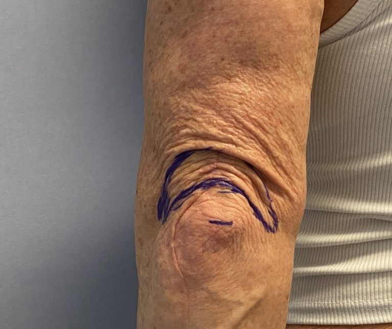 elbow lift markings arm extended Dr Barry Eppley - Explore Plastic Surgery