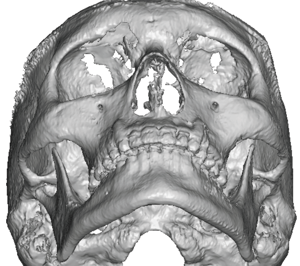 Plastic Surgery Case Study - Custom Infraorbital-Malar Implants for Eye ...