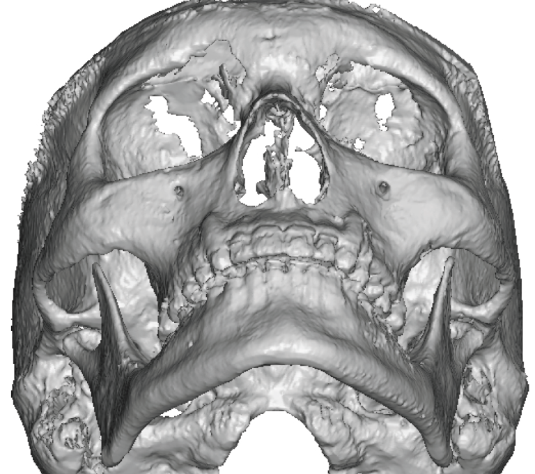 eye cheek asymmetry 3D CT scan submental view Dr Barry Eppley - Explore ...