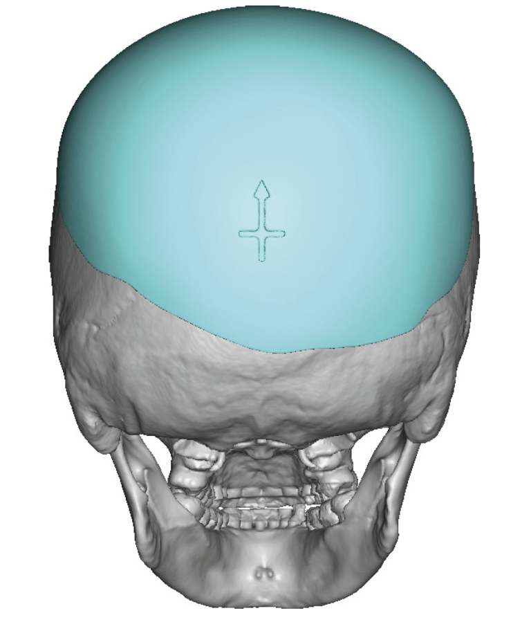 Technical Strategies - Hair Management in Female Aesthetic Skull Implant Augmentations - Explore ...