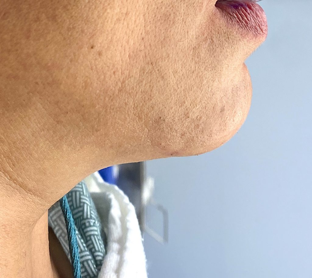 Plastic Surgery Case Study - The Modified Anatomic Chin Implant for ...