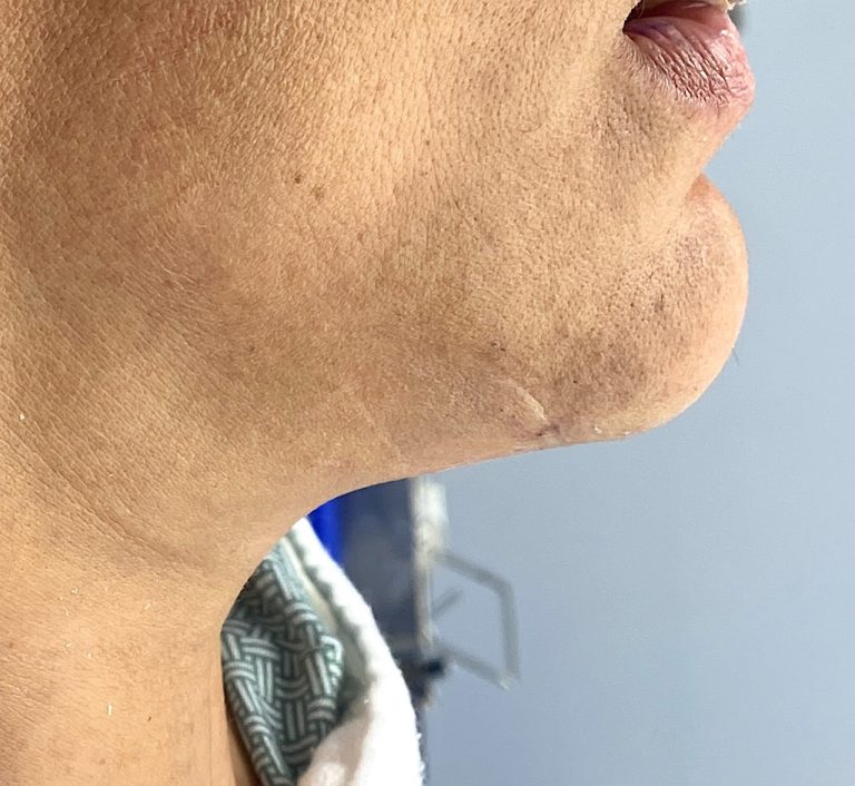 female chin implant intraop side 2 Dr Barry Eppley - Explore Plastic ...