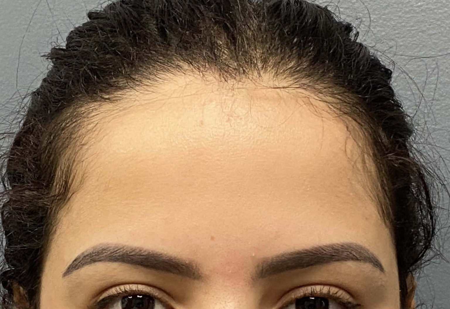 Plastic Surgery Case Study - Bony and Soft Tissue Forehead Reductions ...