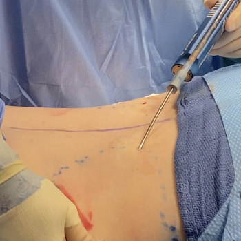 Blog - Page 2 of 589 - Explore Plastic Surgery