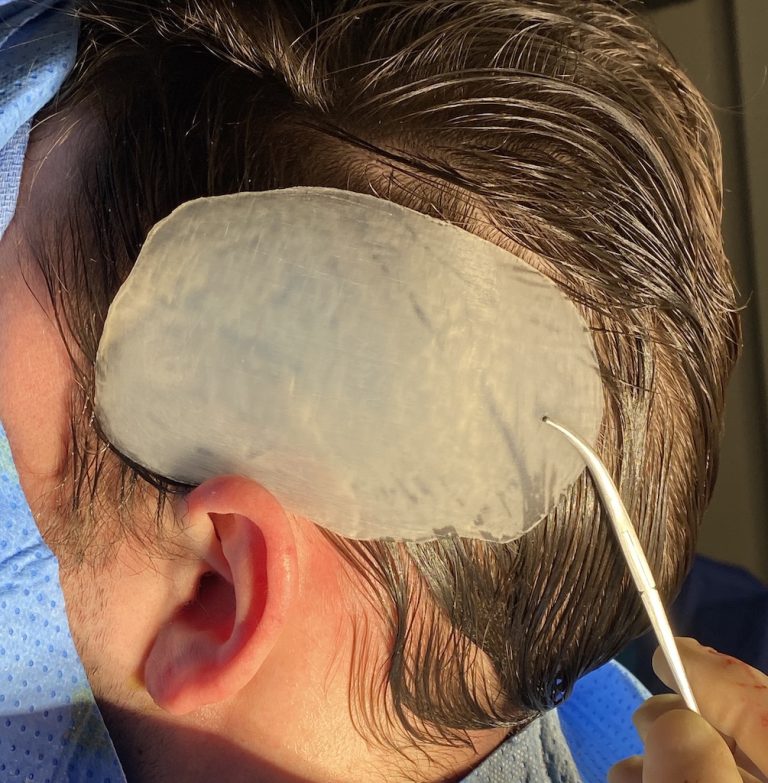 head widening implant placement location intraop Dr Barry Eppley ...