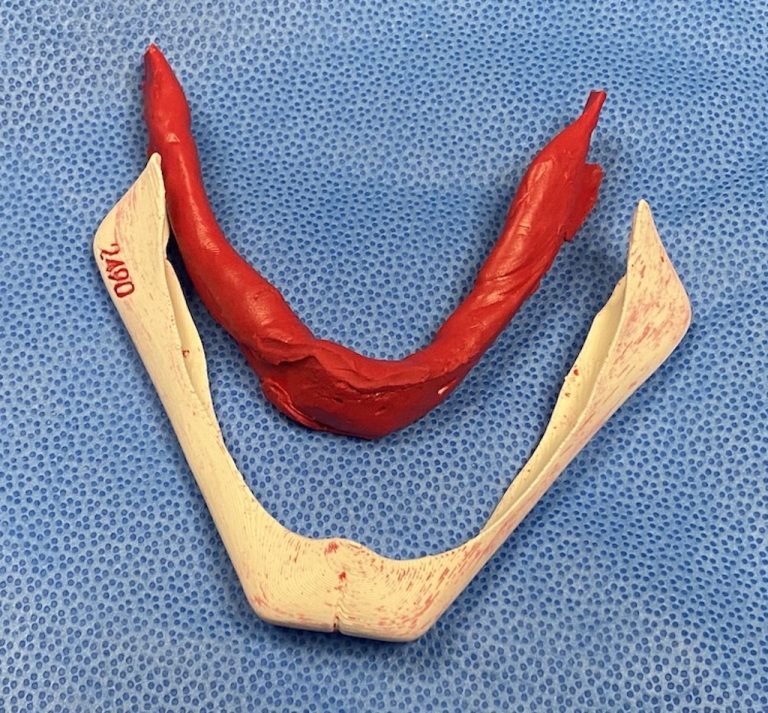 jawbone impression from custom jawline implant model front view Dr ...