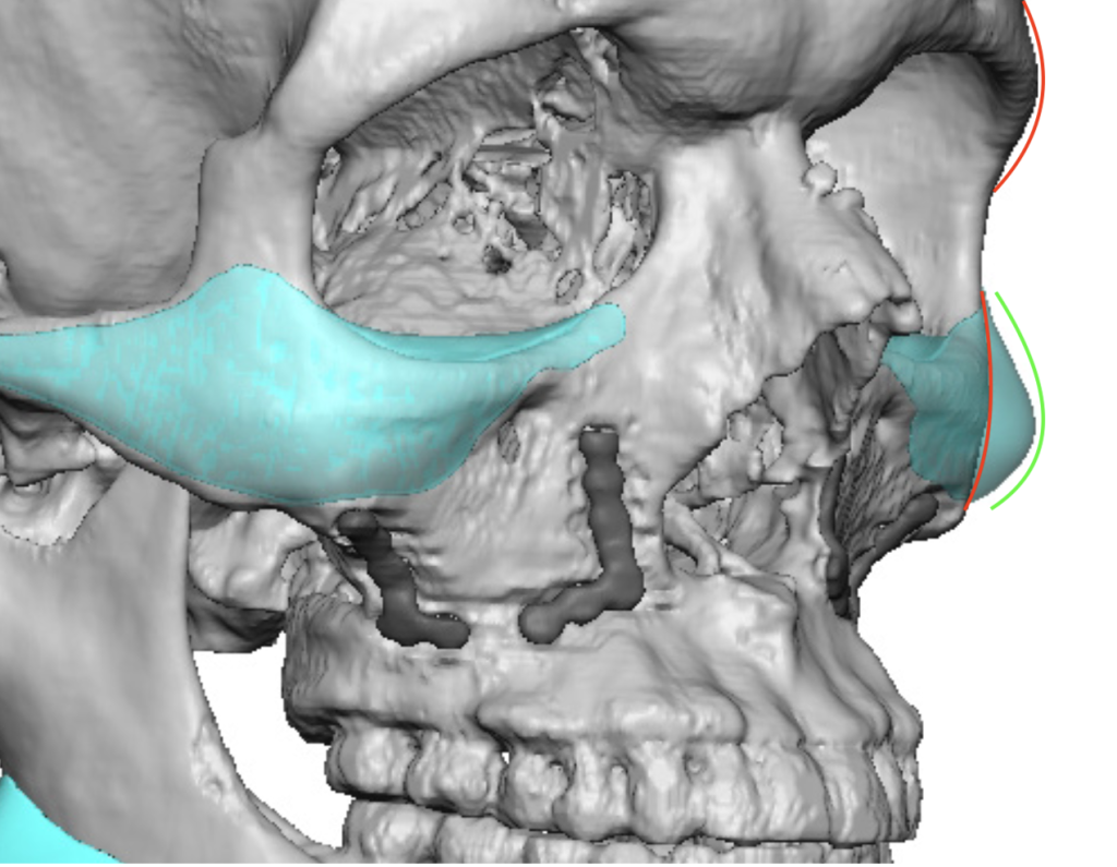 The Custom Infraorbital-Malar Implant in Men and the Ogee Curve ...