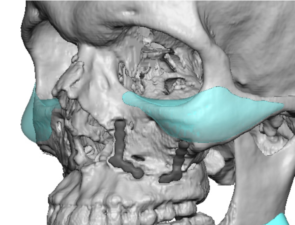 The Custom Infraorbital-Malar Implant in Men and the Ogee Curve ...