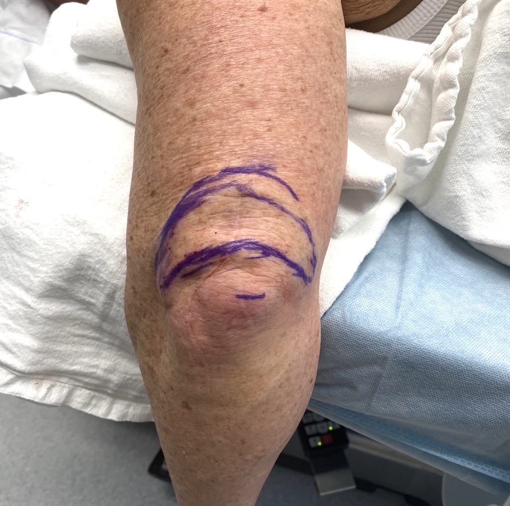 left elbow lift intraop positioning Dr Barry Eppley - Explore Plastic ...