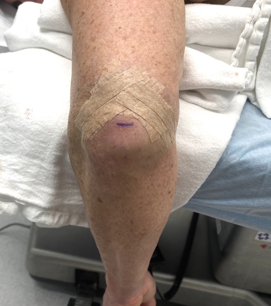 left elbow lift taping Dr Barry Eppley - Explore Plastic Surgery