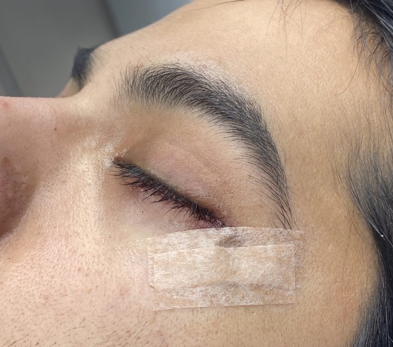 Technical Strategies - Placement of the Custom Infraorbital-Malar ...