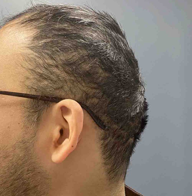 male back of head reduction side 2 Dr Barry Eppley - Explore Plastic ...