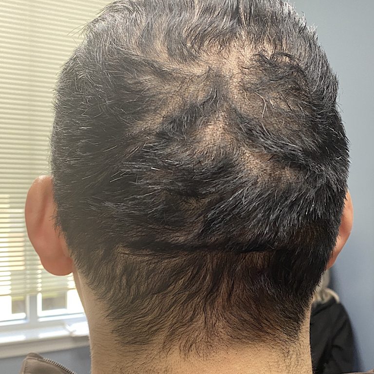 male back of head scalp rolls back 2Dr Barry Eppley - Explore Plastic ...