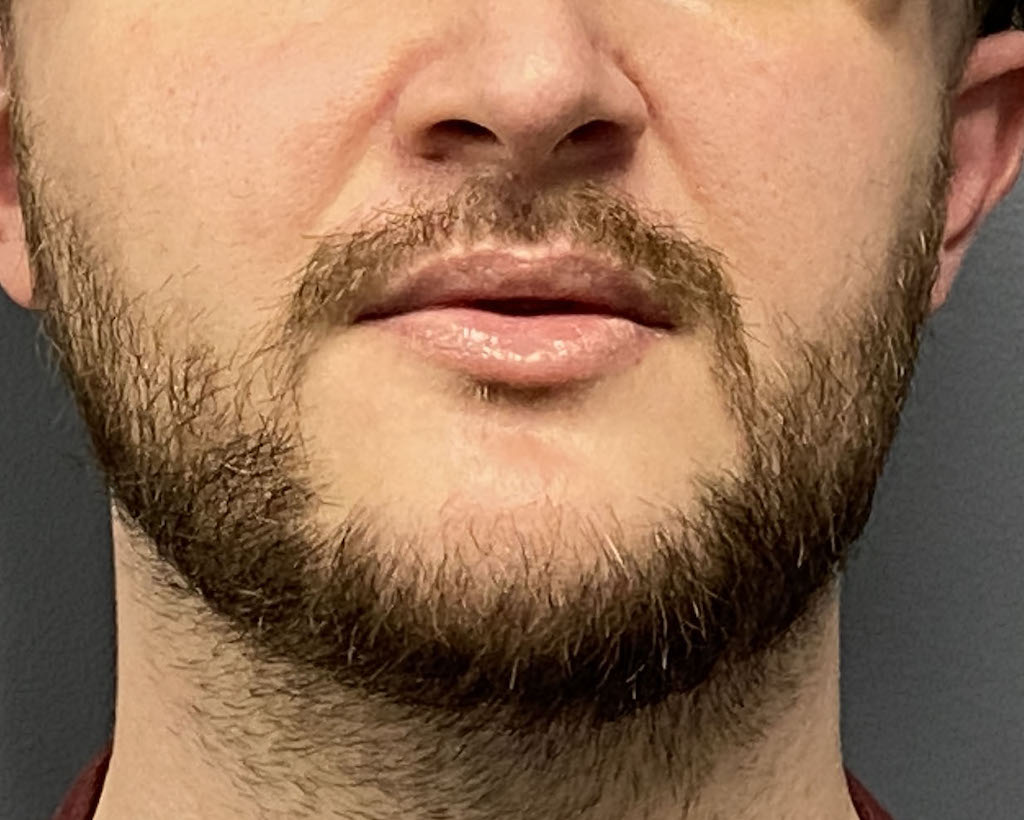 Plastic Surgery Case Study - Lengthening the Vertically Short Chin by ...