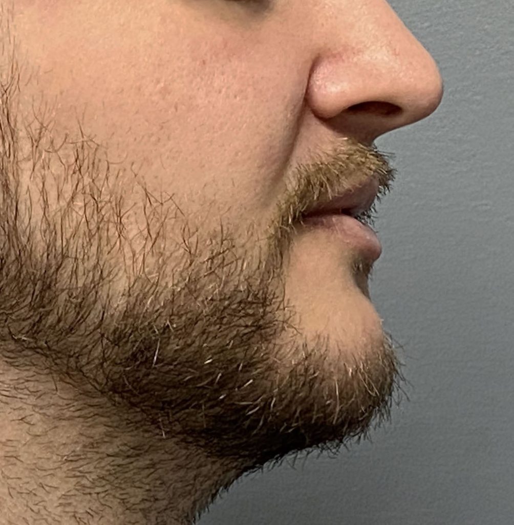 Plastic Surgery Case Study - Lengthening the Vertically Short Chin by ...