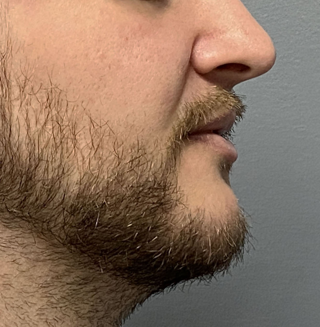 Plastic Surgery Case Study - Lengthening the Vertically Short Chin by ...