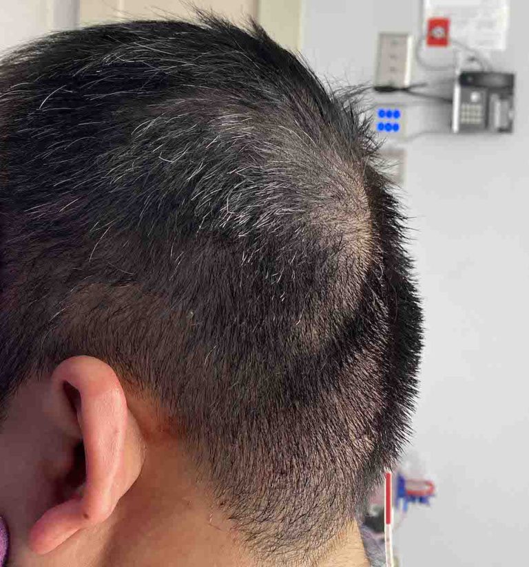 Plastic Surgery Case Study - Prominent Nuchal Ridge Bony Reduction with ...