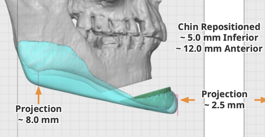 Plastic Surgery Case Study - Combining a Large Bony Genioplasty ...