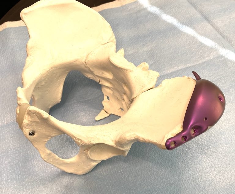 Pelvis Plasty for Upper Hip Widening - Iliac Crest Plate Design ...