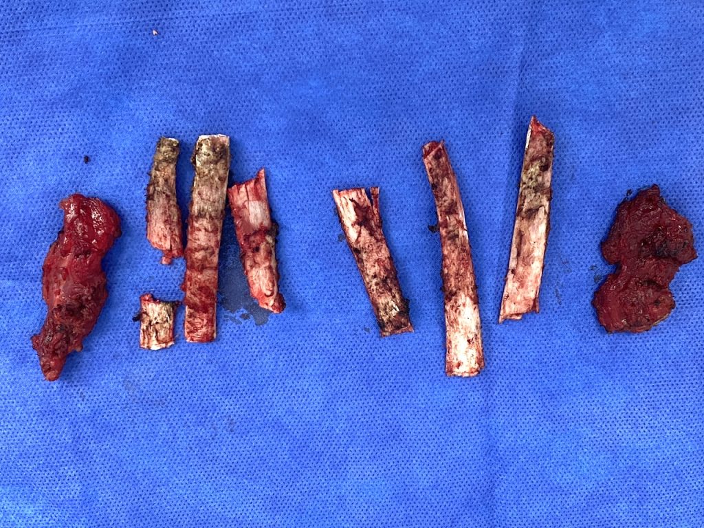 Plastic Surgery Case Study - Transfemale Shoulder Reduction and Rib ...