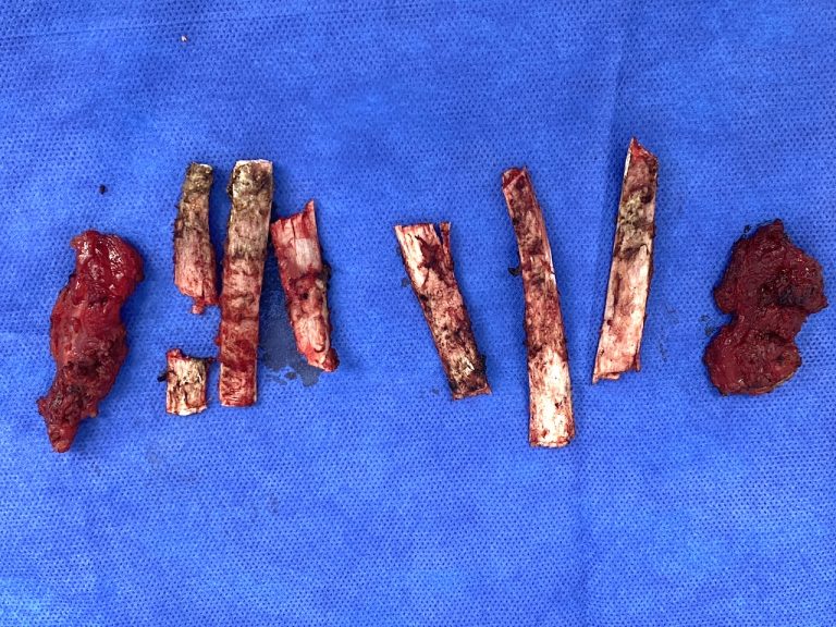 Plastic Surgery Case Study - Transfemale Shoulder Reduction and Rib ...