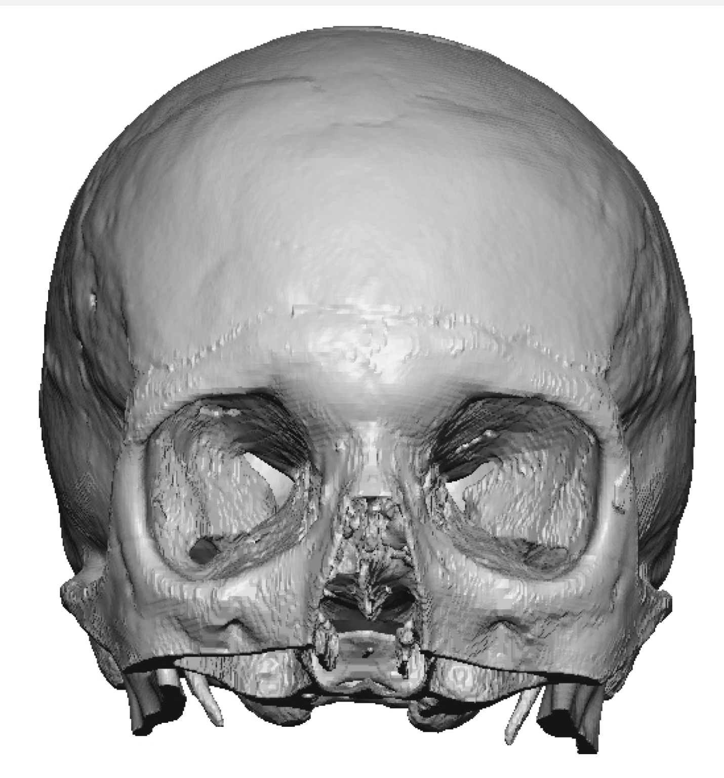 Plastic Surgery Case Study - Large Two Piece Surface Area Skull Implant ...