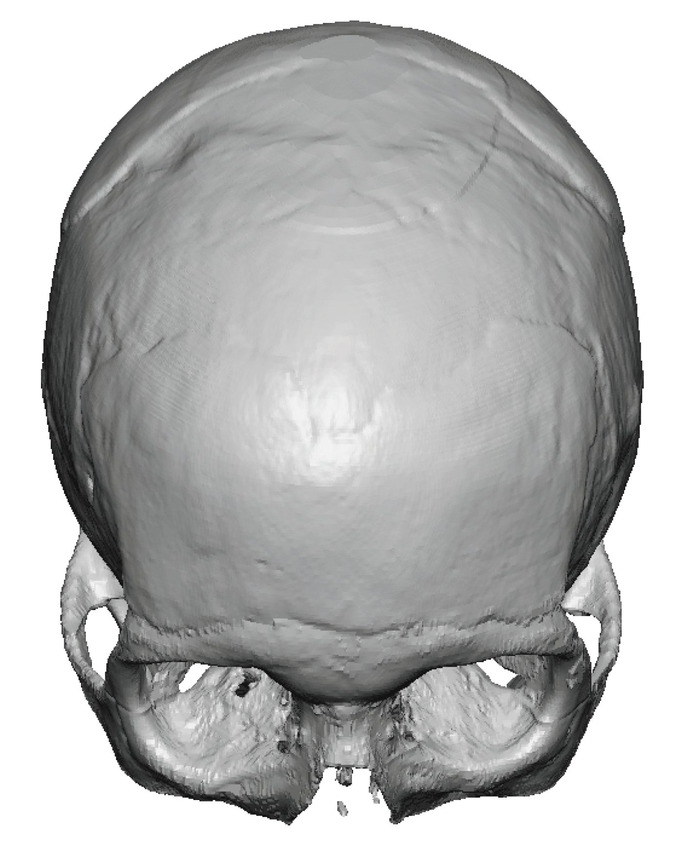 Plastic Surgery Case Study - Large Two Piece Surface Area Skull Implant ...