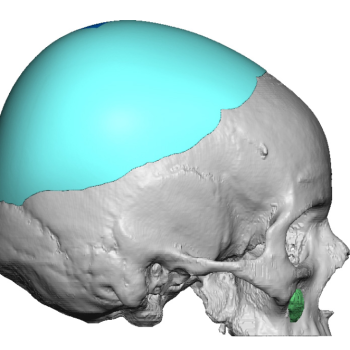 skull reshaping Archives - Explore Plastic Surgery