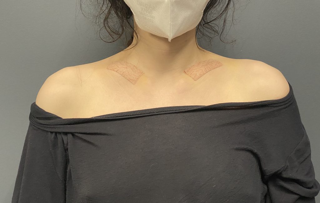 Plastic Surgery Case Study - Long Term Appearance of the Clavicles in ...