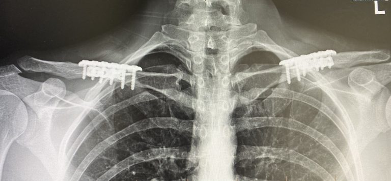 female shoulder reduction postop xray Dr Barry Eppely - Explore Plastic ...