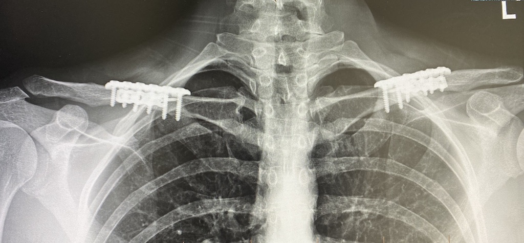 Plastic Surgery Case Study - Transfemale Shoulder Reduction and Rib ...