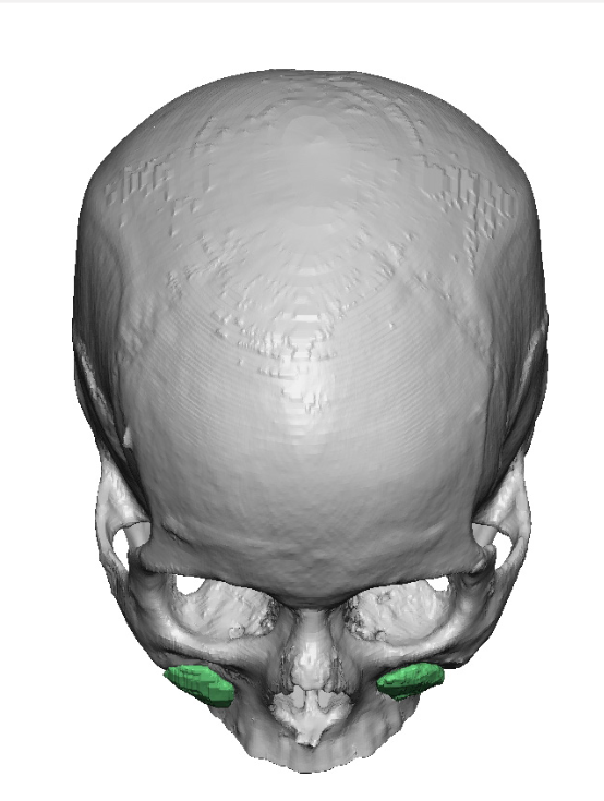 Plastic Surgery Case Study - Large Female Two Stage Skull Augmentation ...