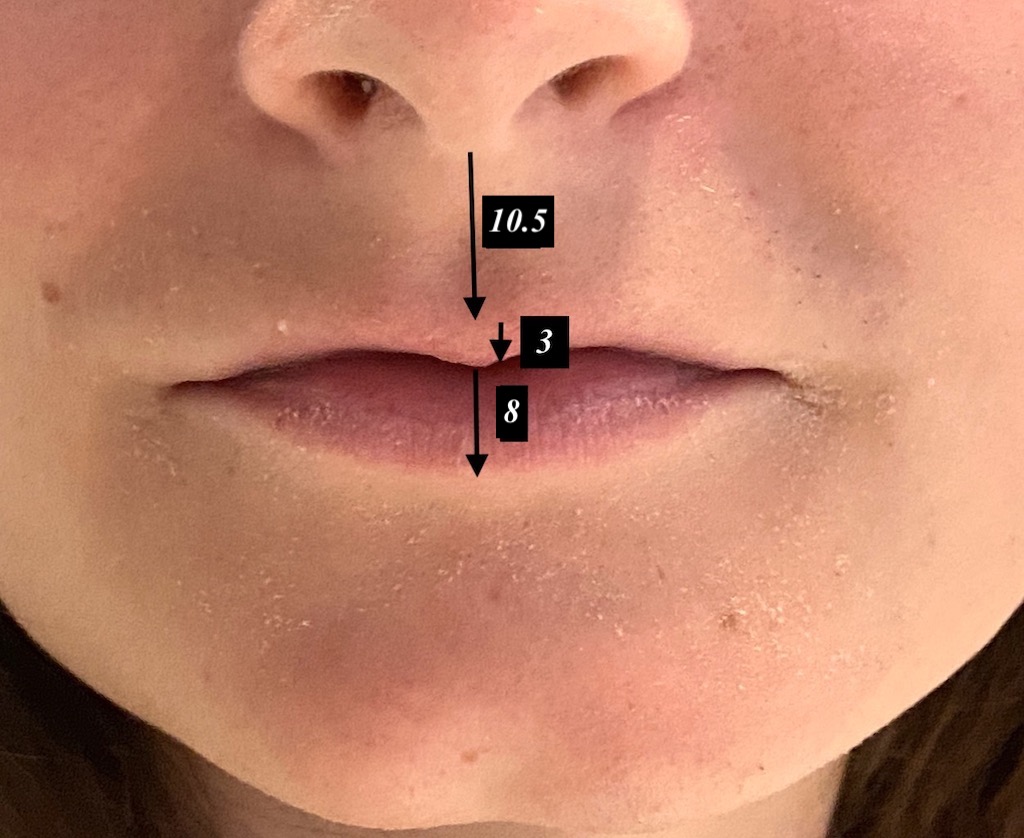 Plastic Surgery Case Study - Vermilion Advancement in the Short Pencil ...