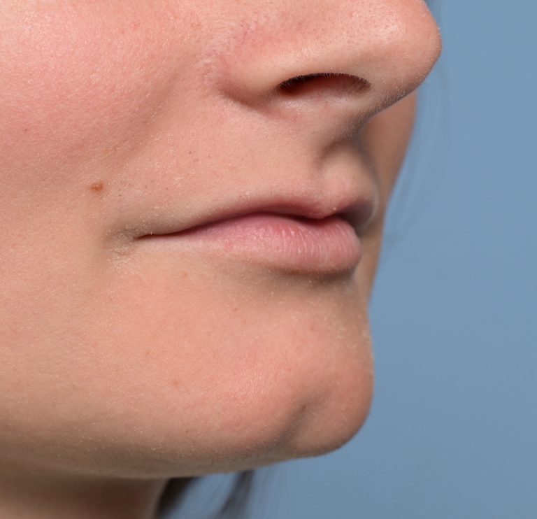 Plastic Surgery Case Study - Vermilion Advancement in the Short Pencil ...