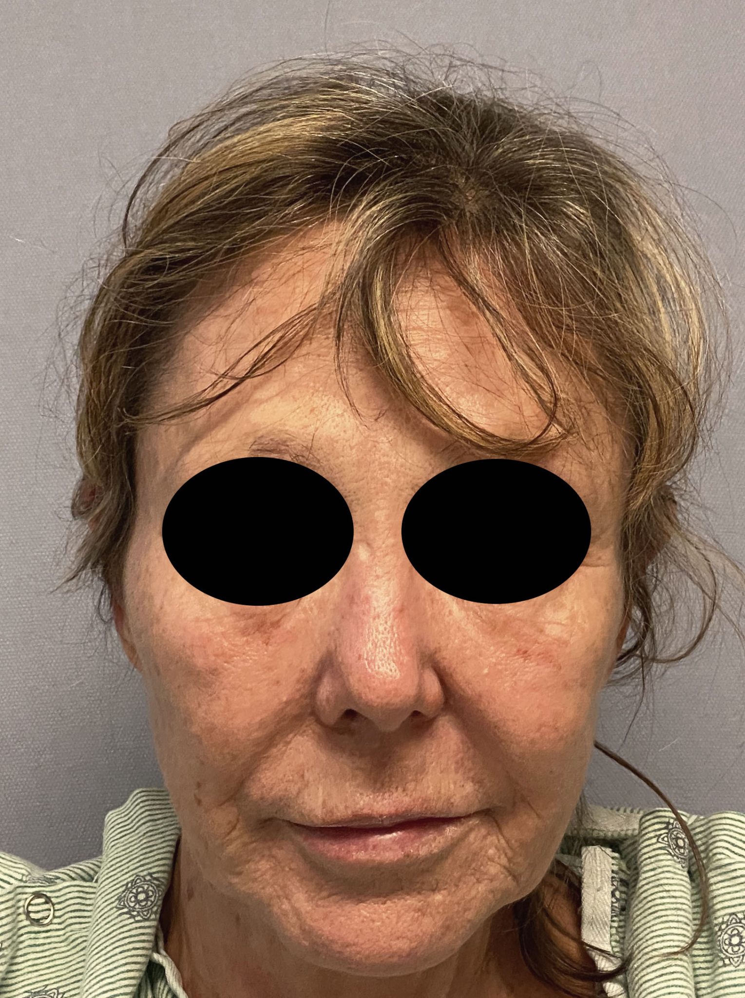 Plastic Surgery Case Study - Large Two Piece Surface Area Skull Implant ...