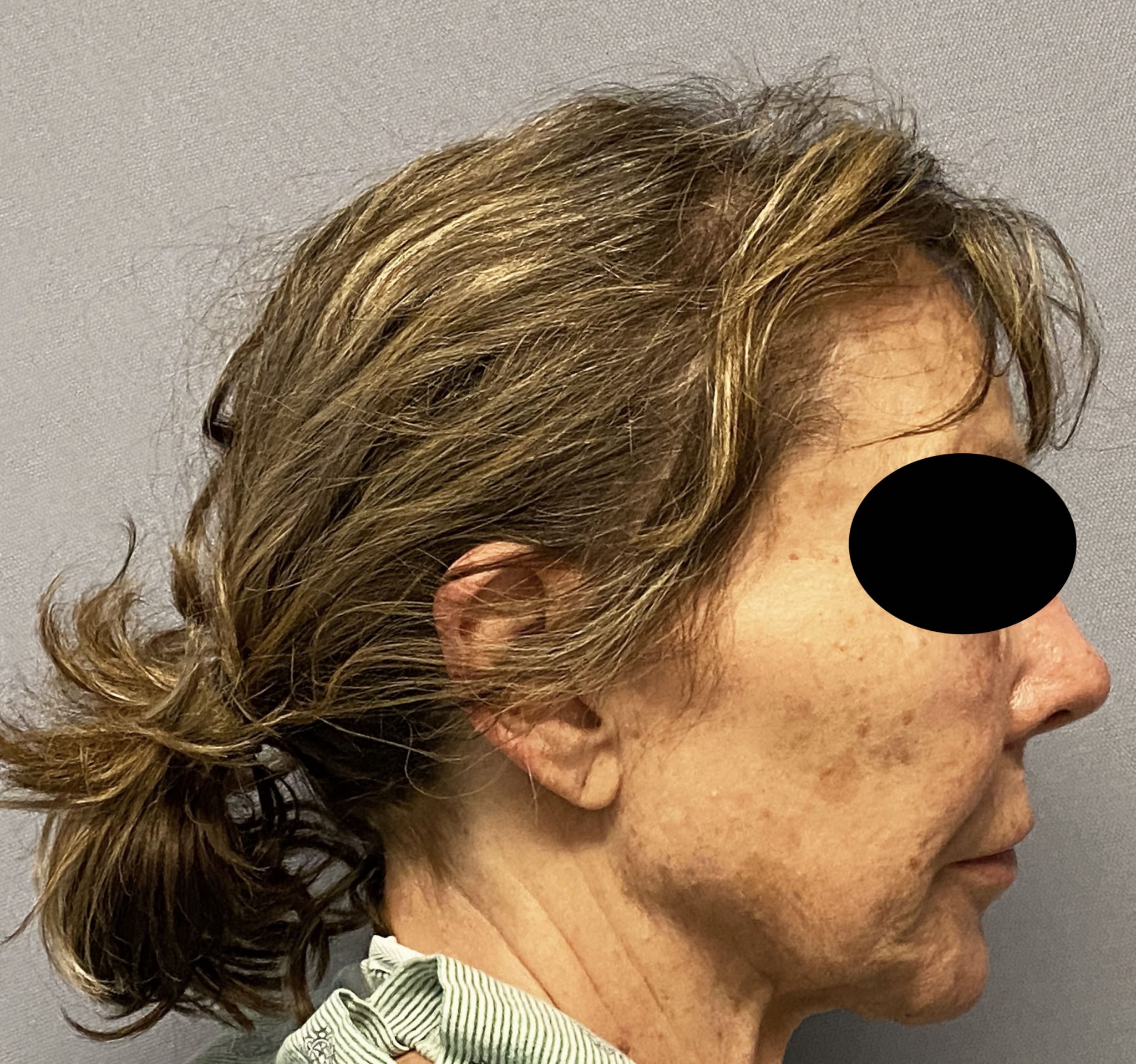 Plastic Surgery Case Study - Large Two Piece Surface Area Skull Implant ...