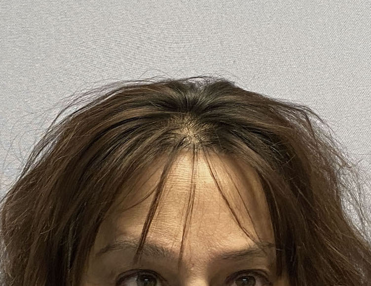 Plastic Surgery Case Study - Large Female Two Stage Skull Augmentation ...