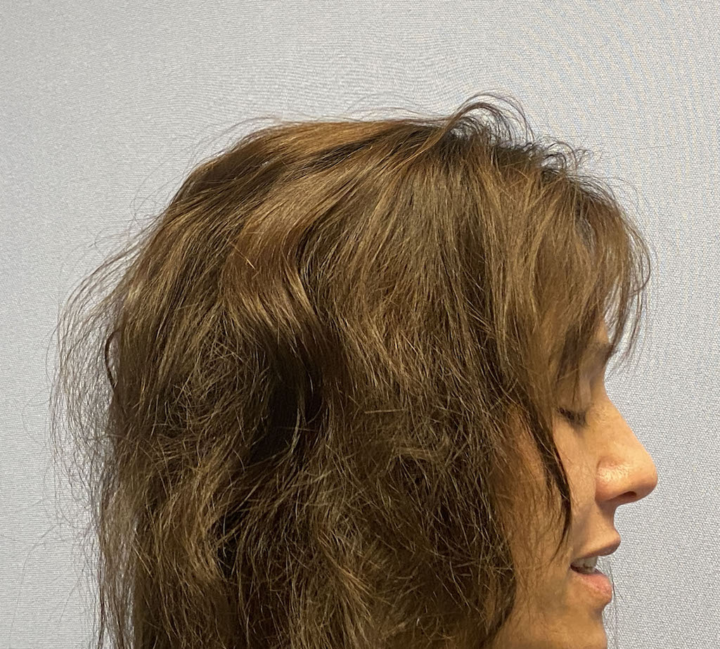 Plastic Surgery Case Study - Large Female Two Stage Skull Augmentation ...