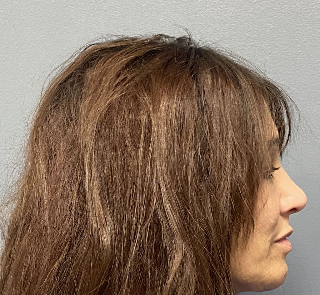 Plastic Surgery Case Study - Large Female Two Stage Skull Augmentation ...