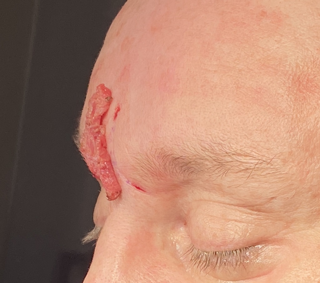 Technical Strategies - Treatment of the Deep Glabellar Furrow with ...