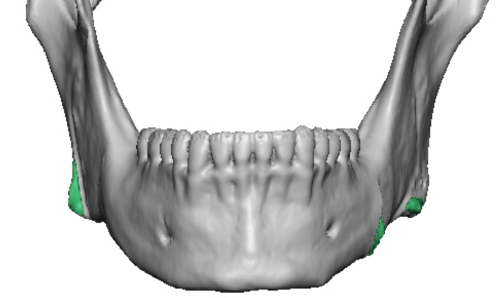 jaw angle implant overgrowth front view Dr Barry Eppley - Explore ...