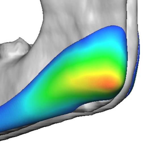 Plastic Surgery Case Study - Custom Jawline Implant with Ligamentous ...
