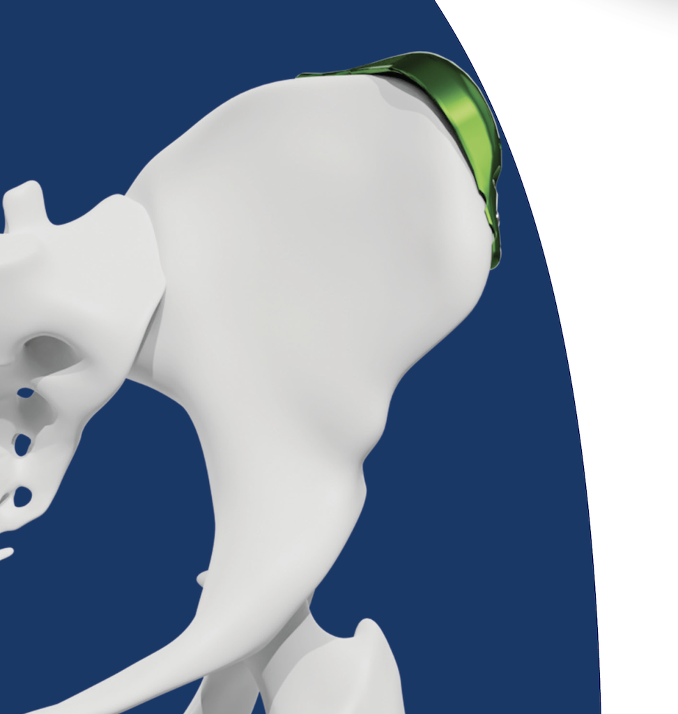 Left 25mm Iliac Crest Plate Illustration Dr Barry Eppley Explore Plastic Surgery