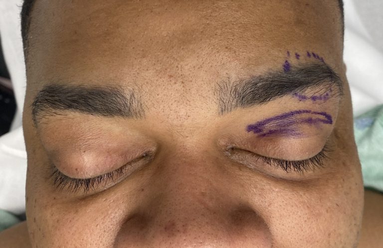 left upper eyelid:brow reconstruction markings Dr Barry Eppley ...