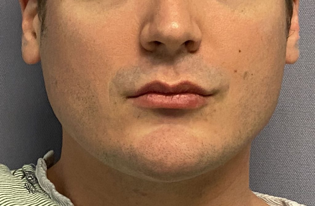male custom jawline implant front 2 cropped Dr Barry Eppley - Explore ...