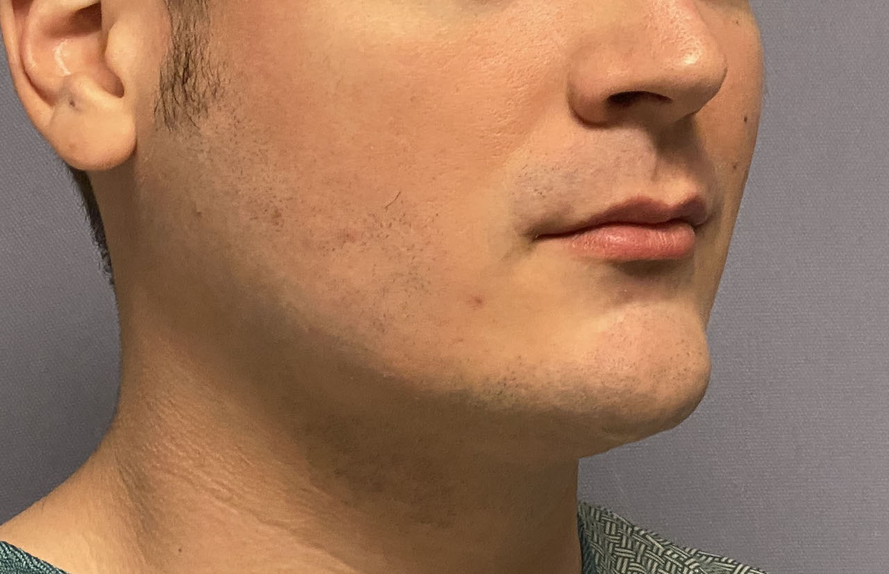 Plastic Surgery Case Study - Custom Jawline Implant with Ligamentous ...